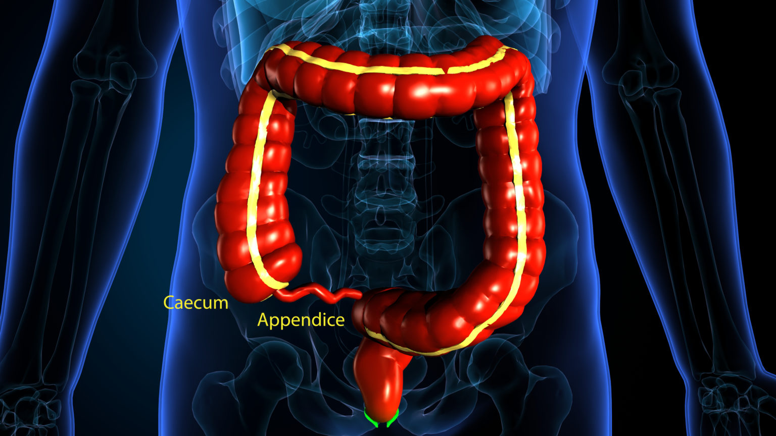 Décodage de l'appendicite - Décodage